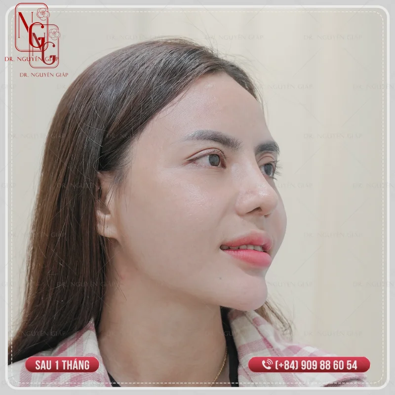 Can I wear a mask after rhinoplasty? - DR Nguyen Giap
